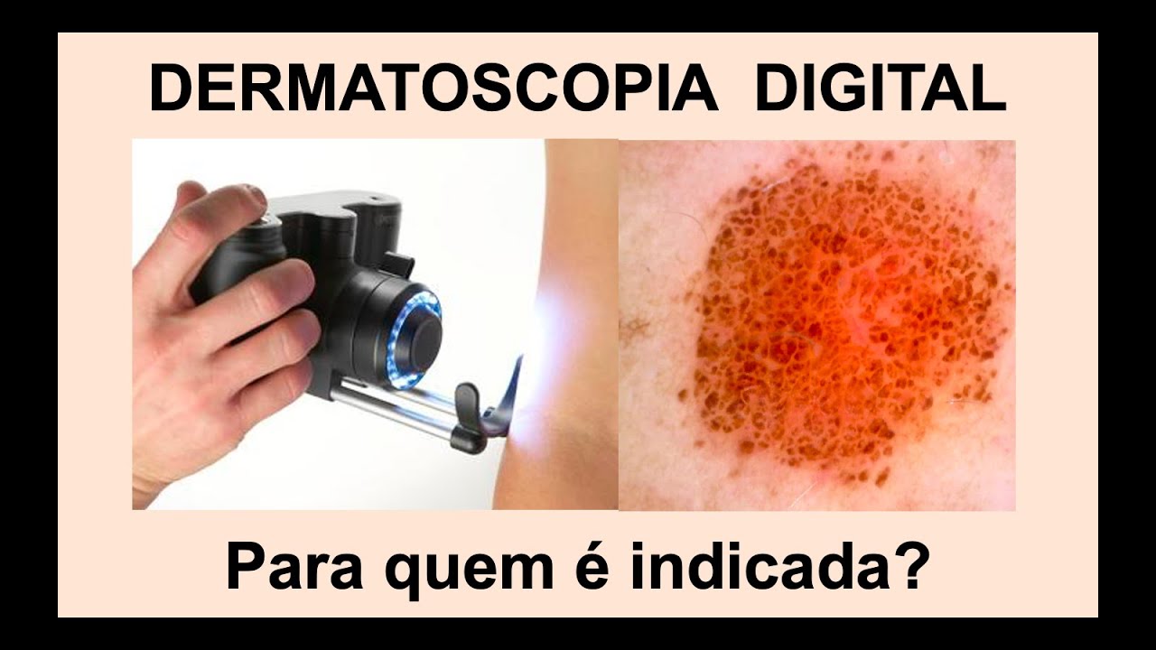 DERMATOSCOPIA DIGITAL - O que é este exame? Para quem está indicado?