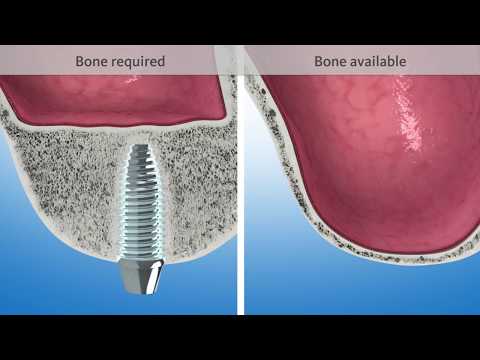 SinusFloorElevation PatientFilm