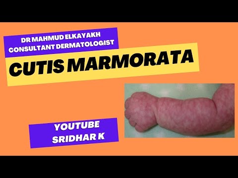 Cutis marmorata l Livedo reticularis #newbornrash #Cutismarmorata
