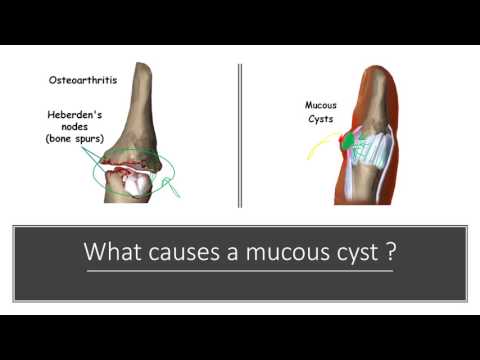 Mucous Cyst Diagnosis and Treatment by Dr. Anzarut