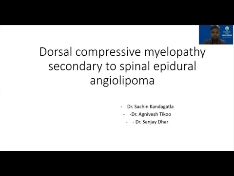Dr Sachin Kandagatla - Dorsal compressive myelopathy secondary to spinal epidural angiolipoma