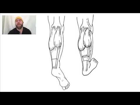 Strayer Procedure for Equinus