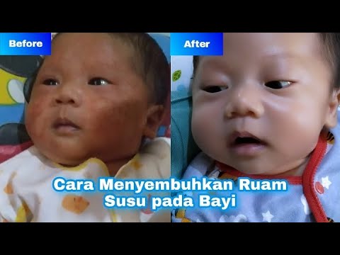 Cara Mengobati Ruam Susu atau Pipi pada Wajah Bayi | Dermatitis Atopik