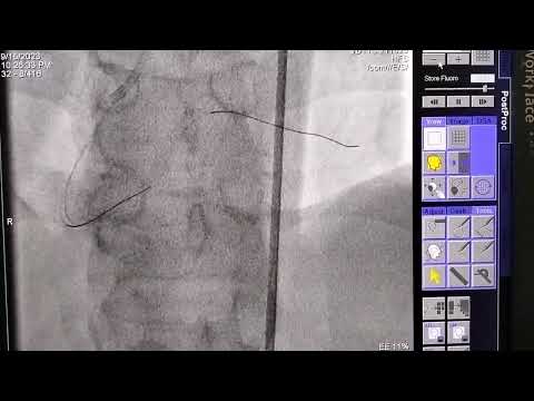 BIFURCATION PRIMARY PCI IN THROMBOTIC RCA - DR. SANDEEP KADAM