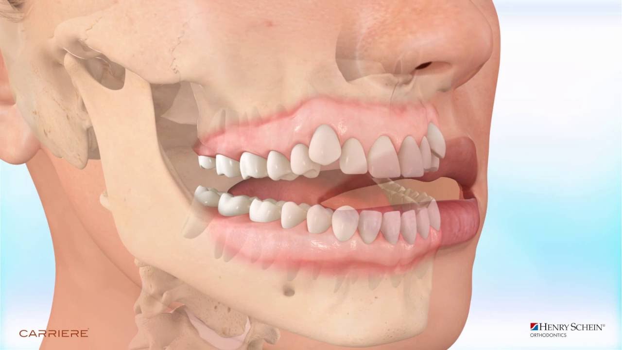 Carriere® Motion™ Appliance for Class III Correction - Patient Education Animation