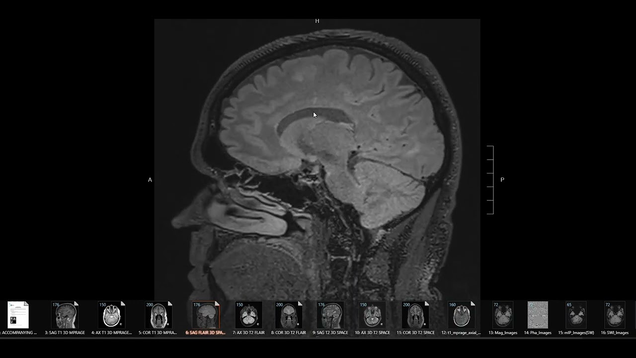What does MS (multiple sclerosis) look like on brain MRI?  Avoid wrongful diagnosis!