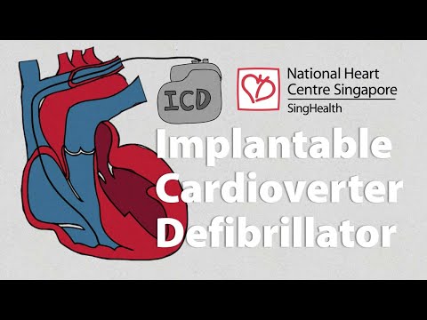 What is an Implantable Cardioverter-Defibrillator (ICD) | What to Expect