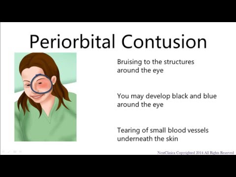 Periorbital contusion with CT