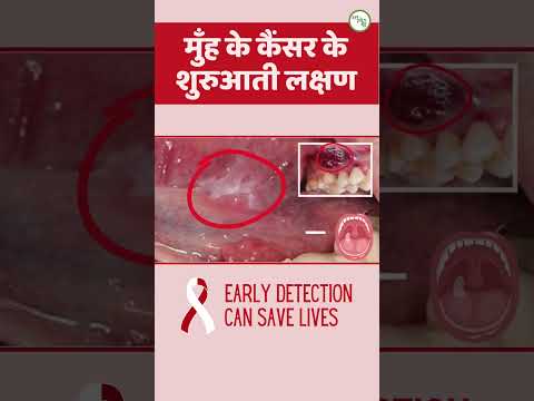 Signs of Oral Cancer #shorts #earlysignsofcancer #mouthcancer #cancerawareness