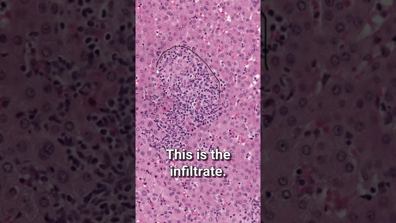 ANOTATING BIOPSIES: A Pathologist Perspective