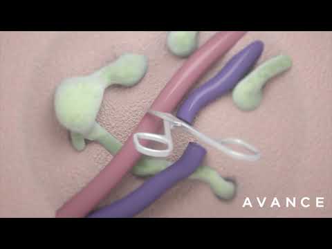 Lymph node Transfer Dr. Erez Dayan Avance Plastic Surgery