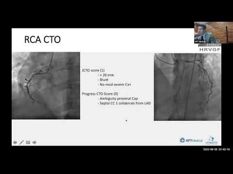 CTO case sharing - Dr. Misael A. Medina Servín