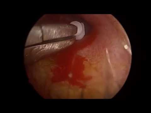 Grommet insertion for glue ear in right ear endoscopic