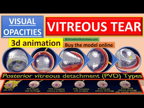 posterior vitreous detachment (pvd) I eye floaters, retinal tears and retinal detachments I
