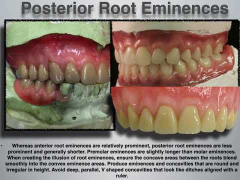 Complete Denture 1 - 11) Wax Characterization