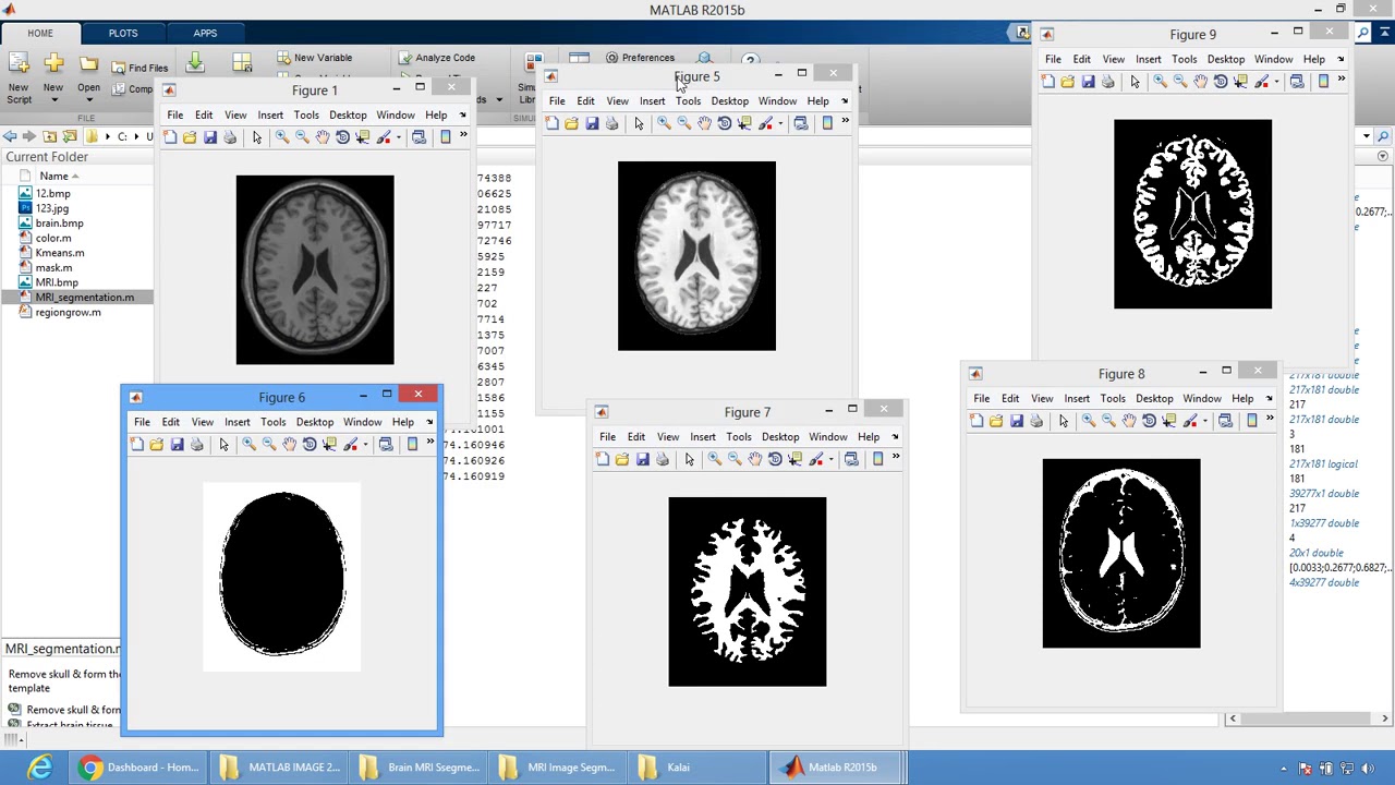 Mri Image Segmentation Using Matlab Okok Projects Final Year Projects Bangalore Chennai