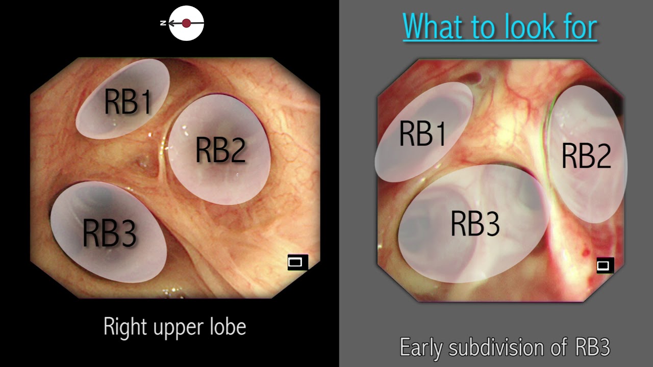 Mastering Bronchoscopy for Thoracic Surgery: Chapter 2