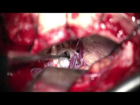 MVD for trigeminal Neuralgia