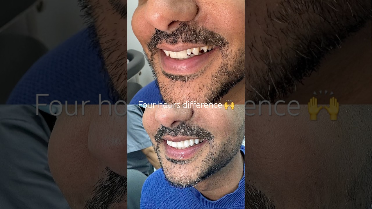 Composite bonding by Dr. Josh 🙌 #compositebonding #smilemakeover