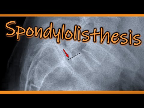 Spondylolisthesis #radiology #anatomy #spine