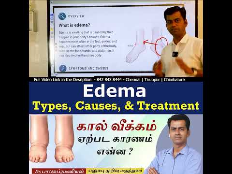 கால்வீக்கம் ஏற்பட காரணம் என்ன? Edema, Causes, Signs and Symptoms, Diagnosis and Treatment in tamil