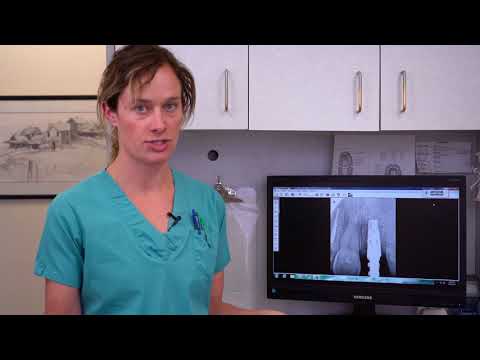 Bozeman Dentist Adavanced Dentistry New Implants and Bridges