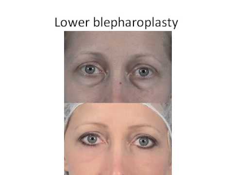 Eye Lid Bleph Explained with Dr. Kotlus