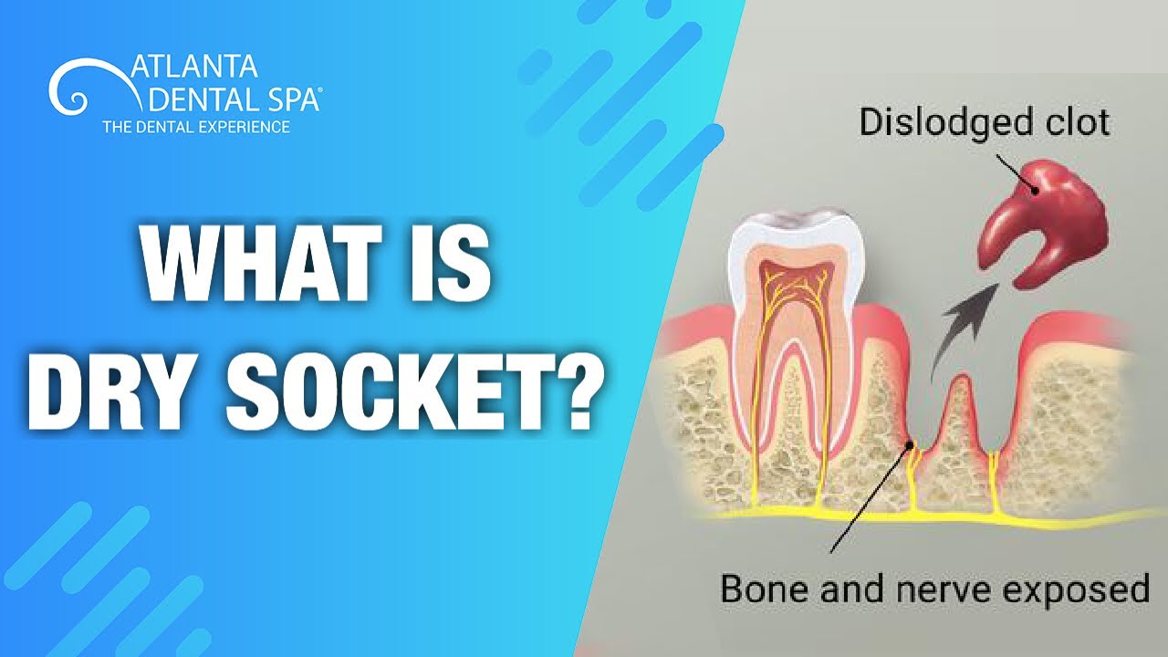 What is Dry Socket? Top dentist says how to Prevent It! | Atlanta Dental Spa (2019)