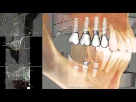 Cornerstone Dental Implants in Hillsborough New Jersey