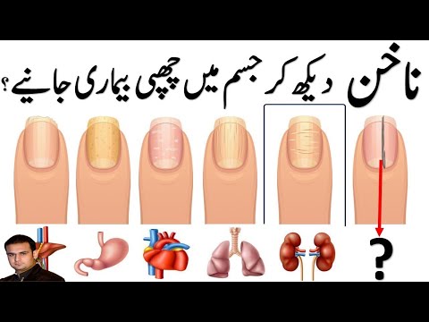 Nails can tell about Hidden diseases (Urdu/Hindi) | Nakhun Dakh kar Jism main chupi bimari jano ?