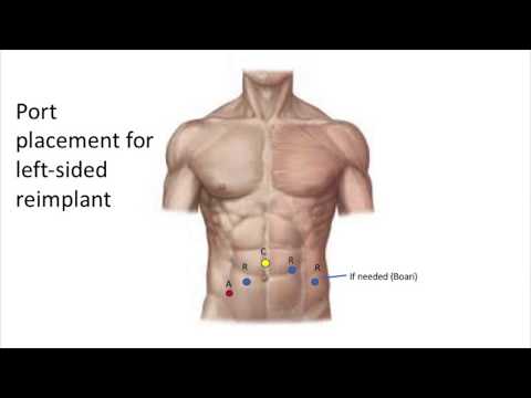 Ureteral Reimplant Bladder Flap