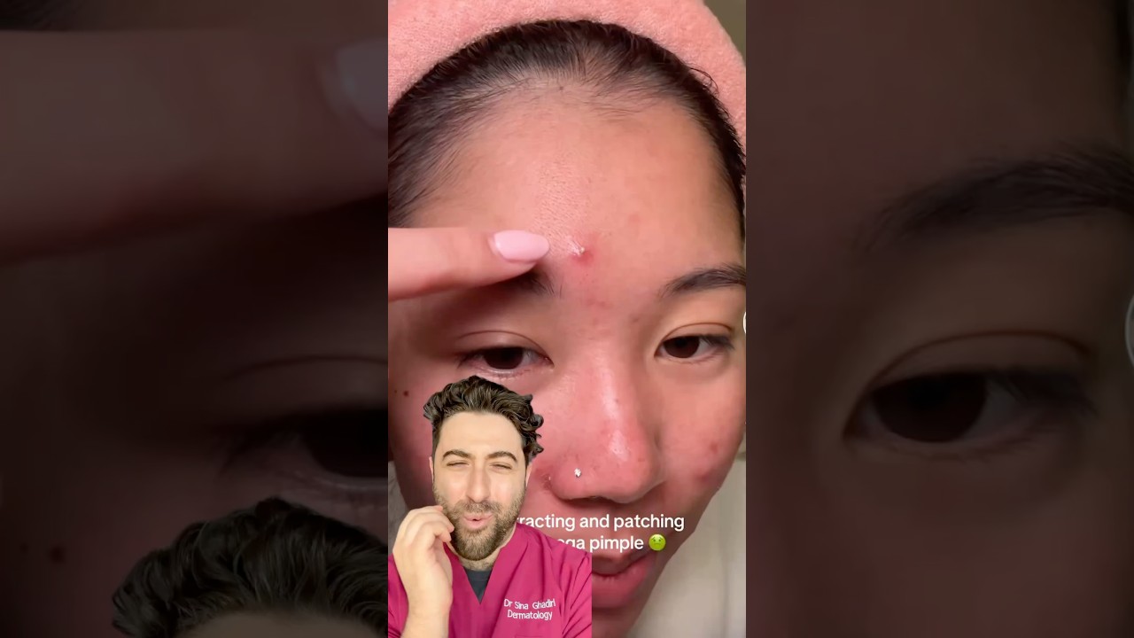 BEWARE the forehead pimple pop