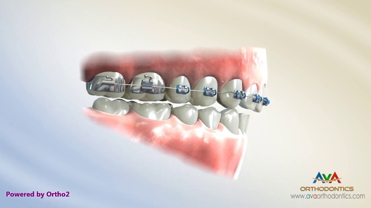 Orthodontic Treatment for Deepbite - Wire with Step Bends
