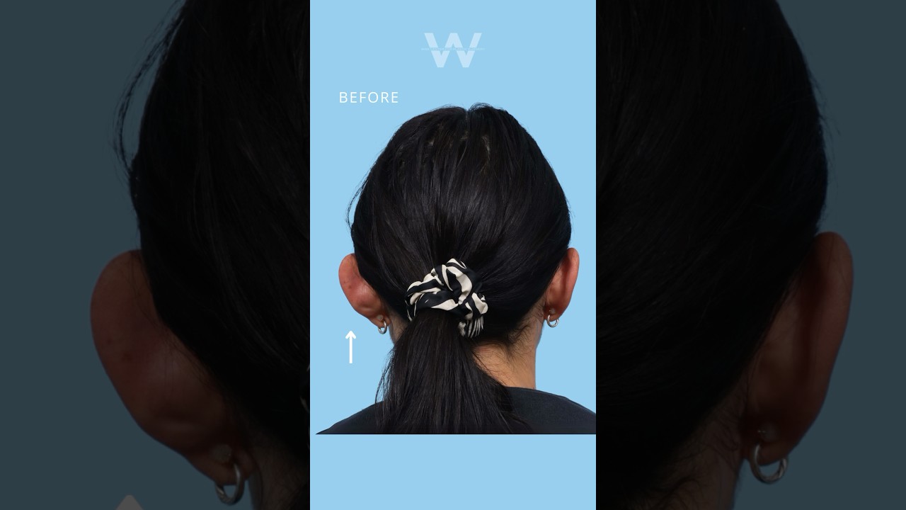 Prominent ears? Dr. Wise can pin them back with an Otoplasty ear procedure, even if it’s just one!