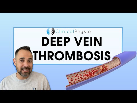 What is a DVT? How do you Diagnose and Treat it? | Expert Explains Everything You Need To Know!