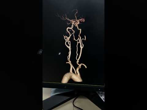 Ct Angiography Neck And Brain /3D Reconstruction of Angio Neck and Brain
