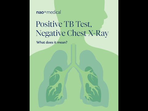 Positive TB Test, Negative Chest X-Ray: What Does It Mean?