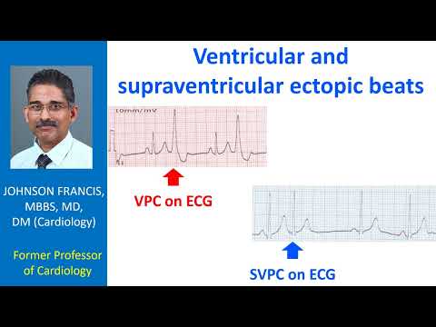 Ventricular and supraventricular ectopic beats