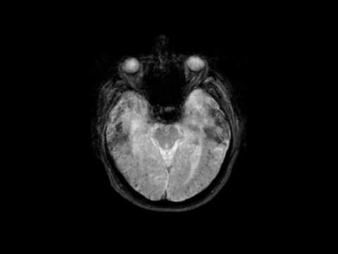 MRI demonstrating sequelae of microbleeds in the brain secondary to hypertension.