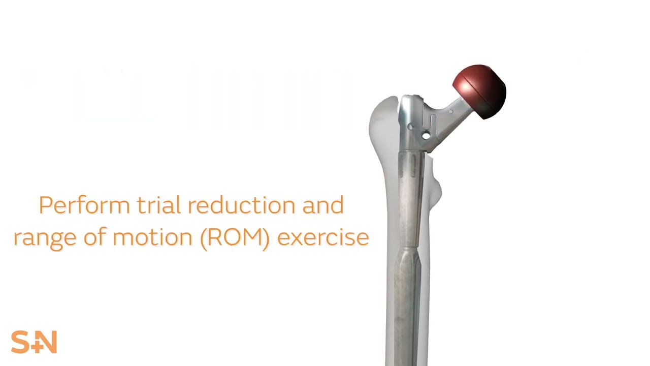 S+N REDAPT Femoral Revision System Overview