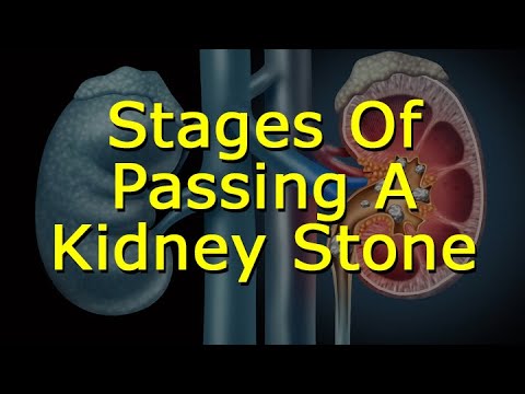 Stages of Passing A Kidney Stone
