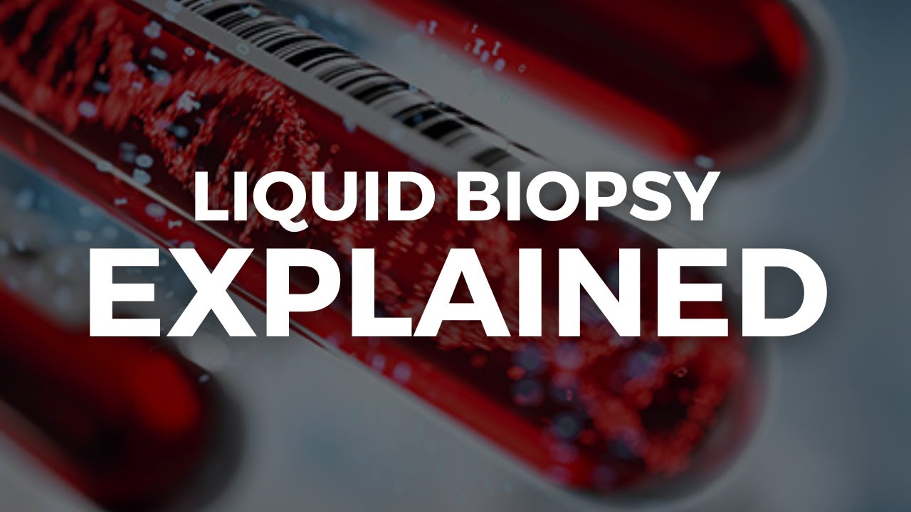 Understanding Liquid Biopsy: A Revolutionary Approach to Cancer ...