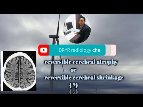 reversible cerebral atrophy or reversible cerebral shrinkage?