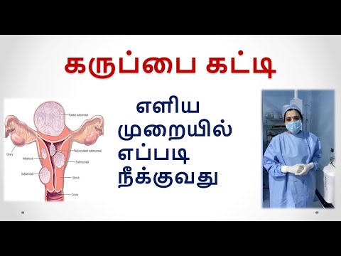 கருப்பை கட்டி | Fibroids | Uterus Removal | Laparoscopic Surgery | Hysterectomy | Dr.Deepa Ganesh.