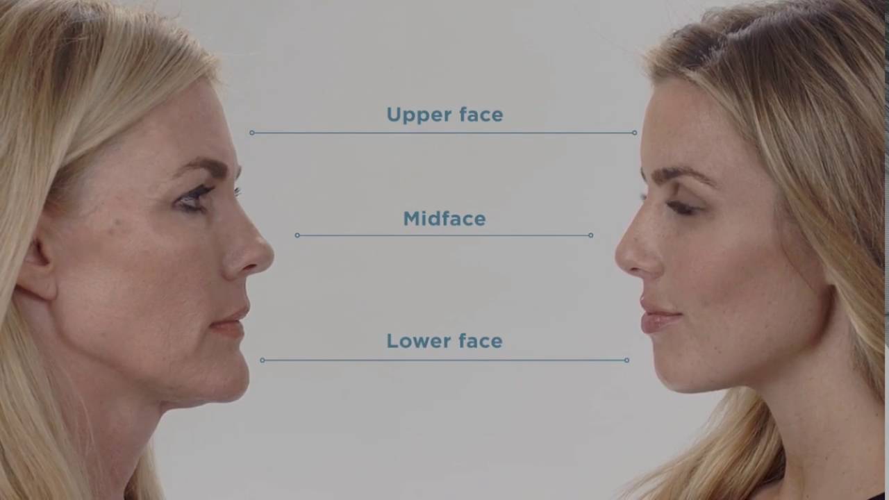 Facial Aging