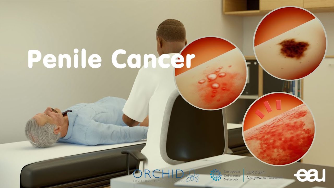 Penile cancer