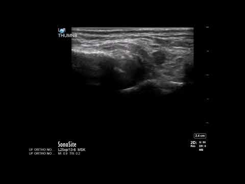Thumb Ultrasound: Carpometacarpal (CMC) Joint Injection