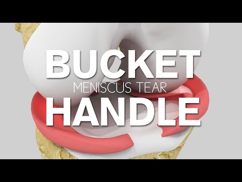 What is a Bucket Handle Meniscus Tear?
