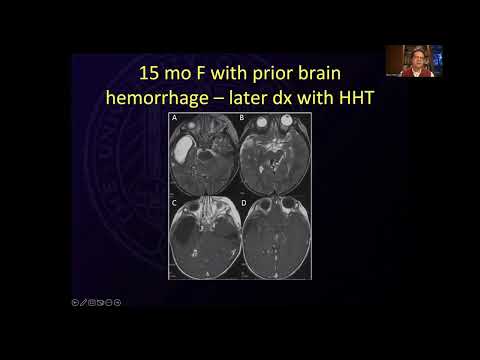 Brain Arteriovenous Malformations and Hereditary Hemorrhagic Telangiectasia (HHT)