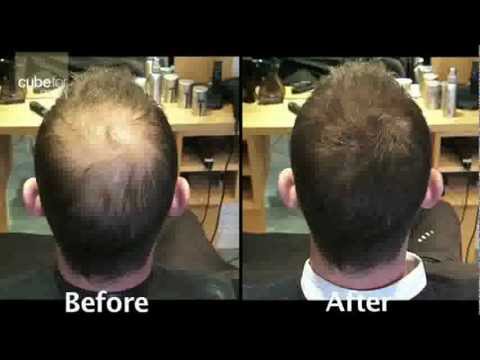 Masalah kepala botak – Cari ubat lebatkan rambut – Wayne Harraz